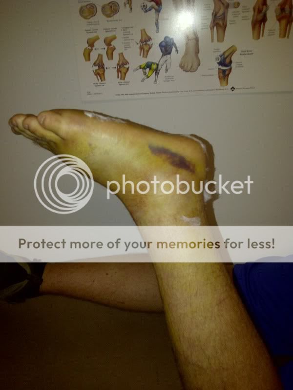 Post Your Disc Golf Injury Pics :thmbup: | Disc Golf Course Review